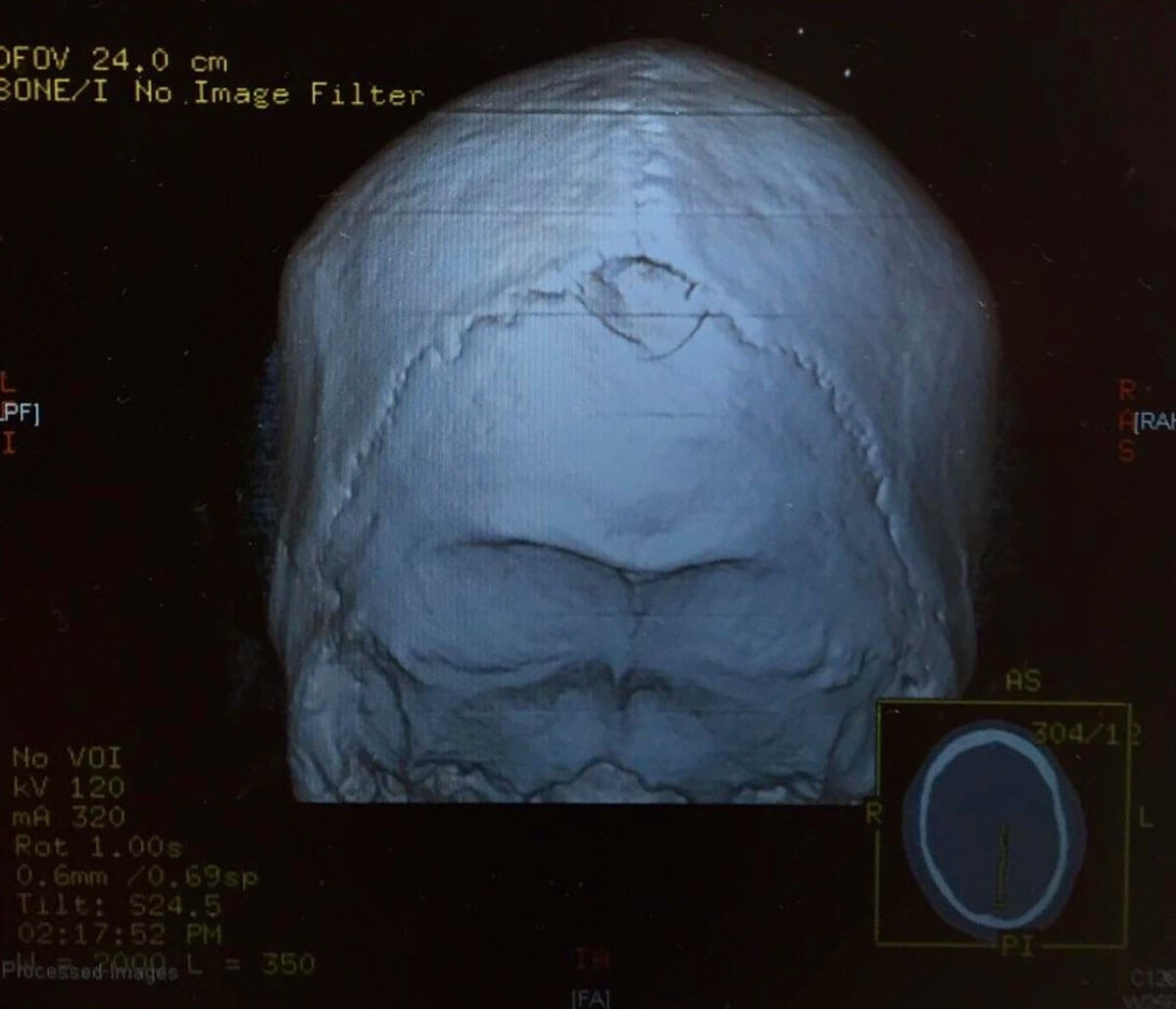 The Life and Times of the Brain-Damaged Gunslinger Clay Allison